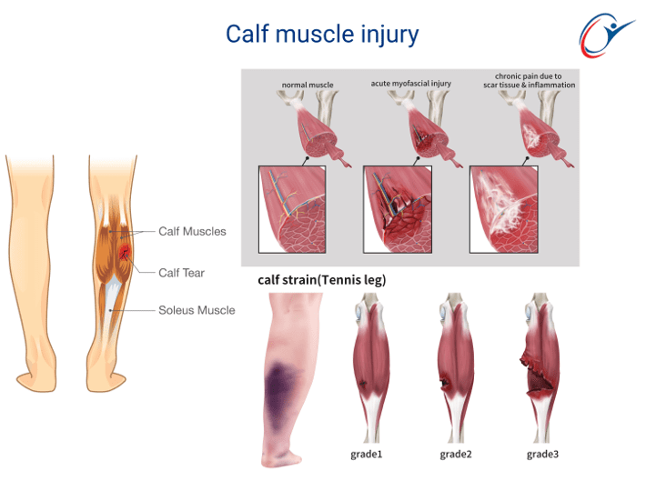 Lower Leg - Acute Calf Muscle Tear | ASSIC Education