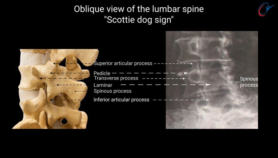 L-spine X-Ray Interpretation | ASSIC Education
